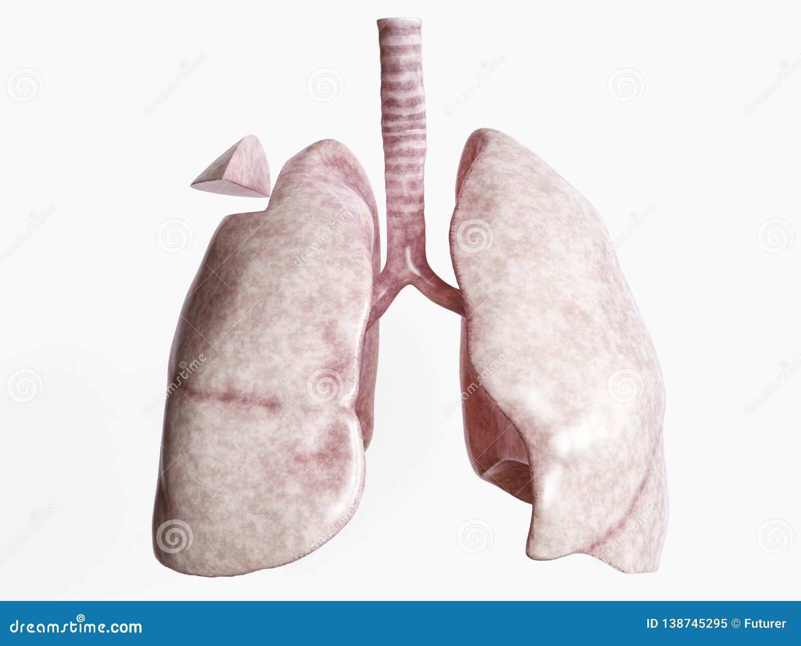 Wedge Resection after Severe Lung Disease - 1 of 4 - 3D Rendering Stock ...