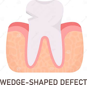 Wedge-Shaped Defect Tooth Problem Stock Illustration - Illustration of ...