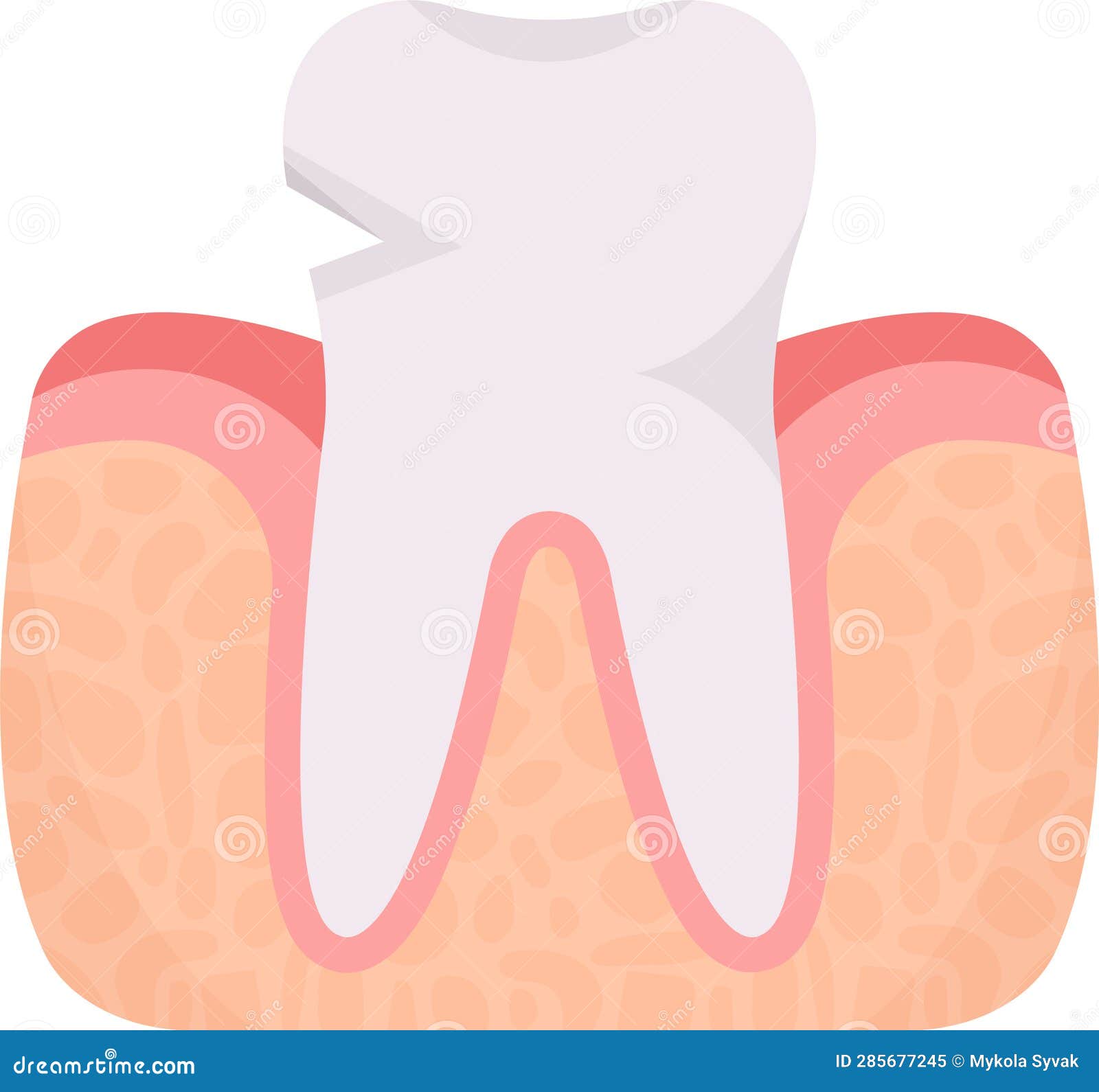 Wedge-Shaped Defect Tooth Problem Stock Vector - Illustration of ...