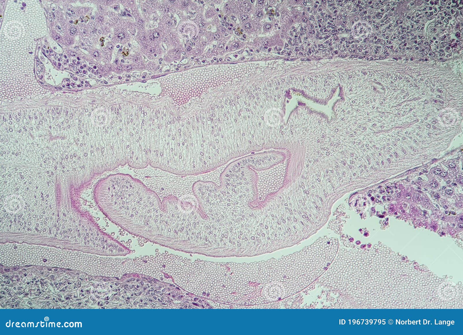 Weefsel Met Schistosomiasis Ziek Weefsel Stock Afbeelding - Image of ...