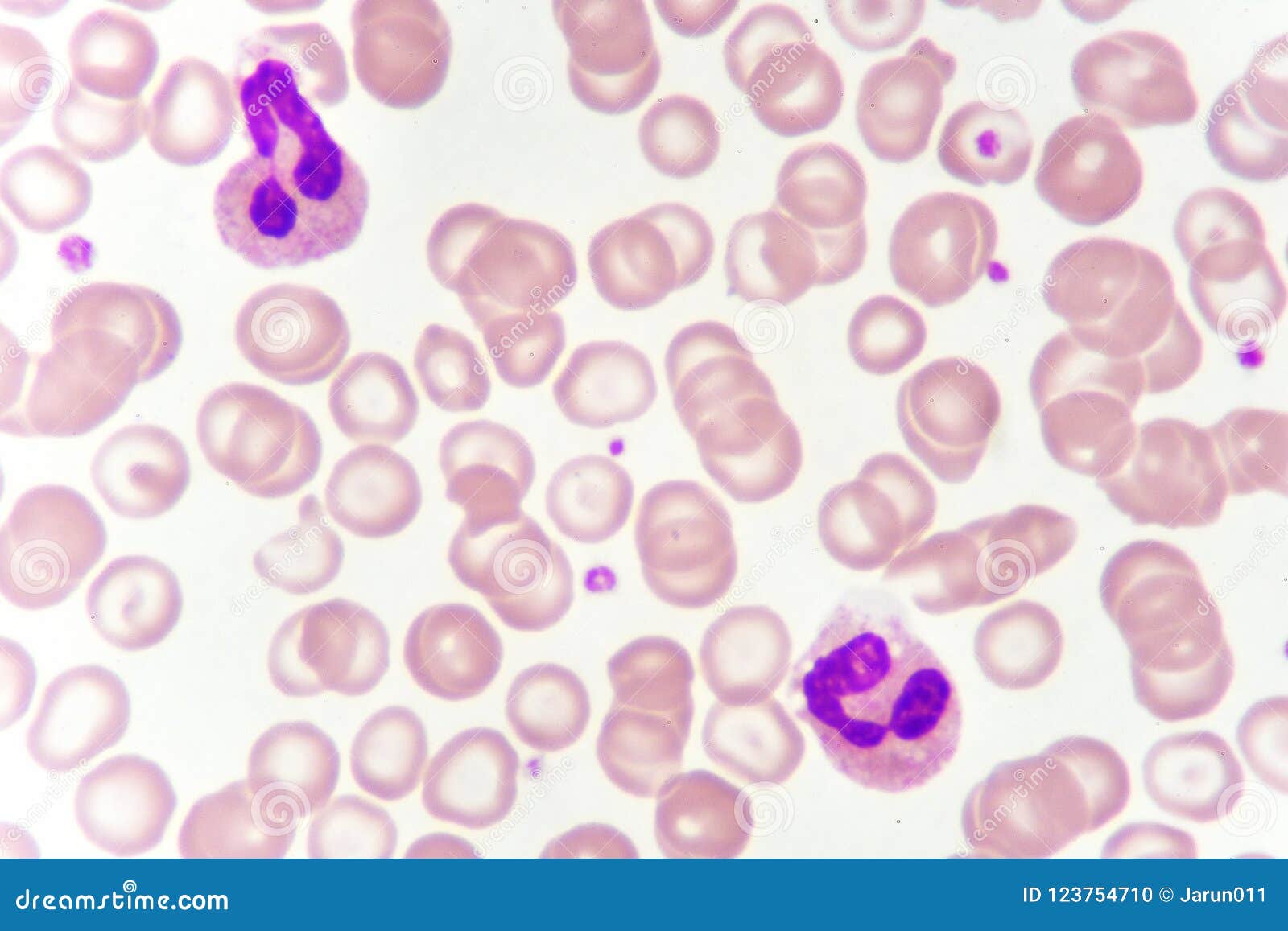 Weiße Blutkörperchen Im Blutausstrich Stockfoto - Bild von labor ...