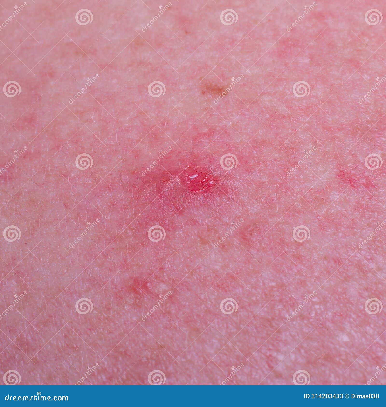 Wet Basalioma on the Skin of an Adult Stock Image - Image of basalioma ...