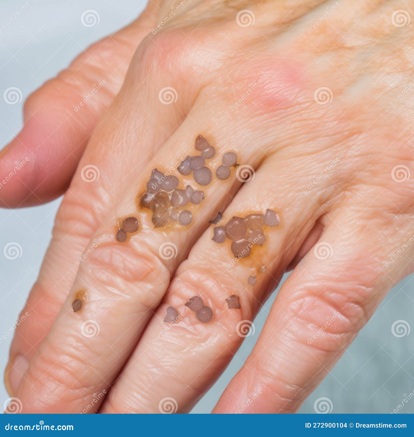 What Are Some Natural Remedies For Warts . AI Generation Royalty-Free ...