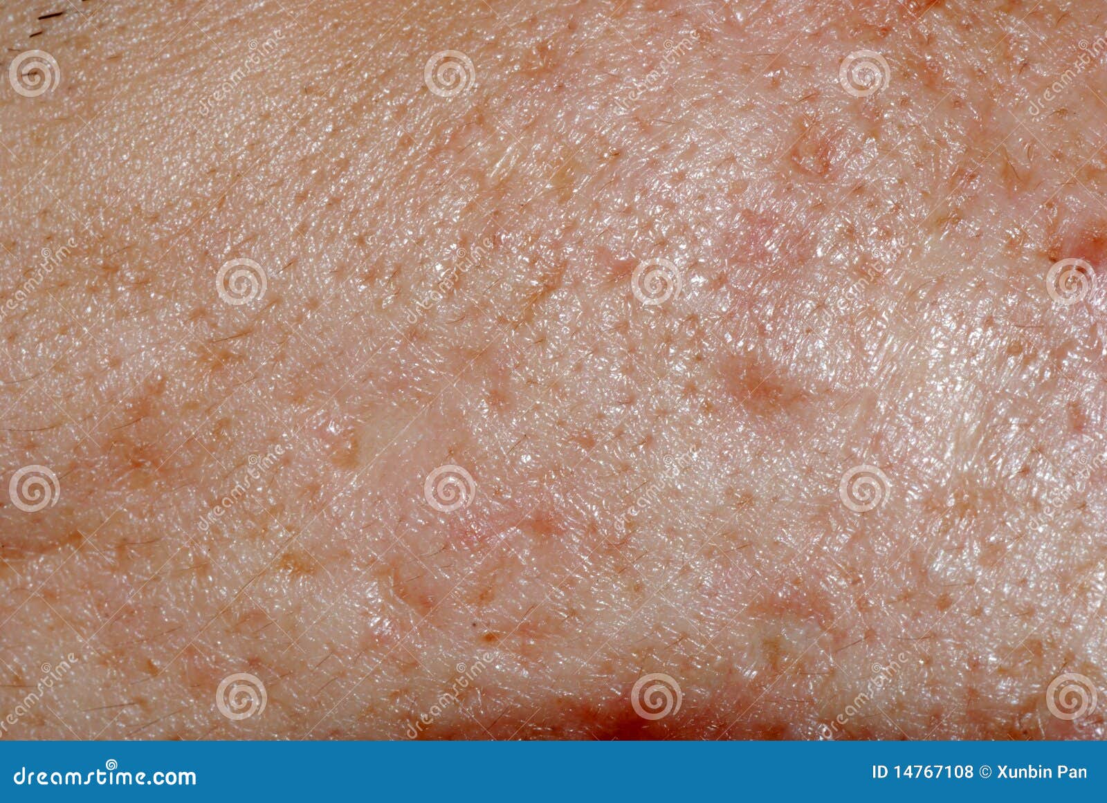 Pimple Texture, Air-bubble, Bubbles Background Stock Image ...