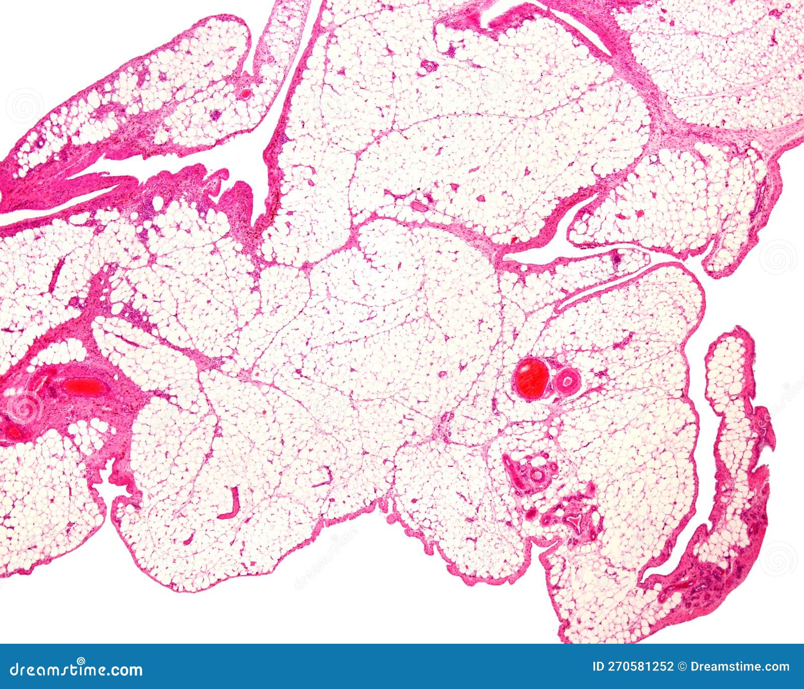 Human Appendix. Eosinophils Stock Photo - Image of appendicitis ...