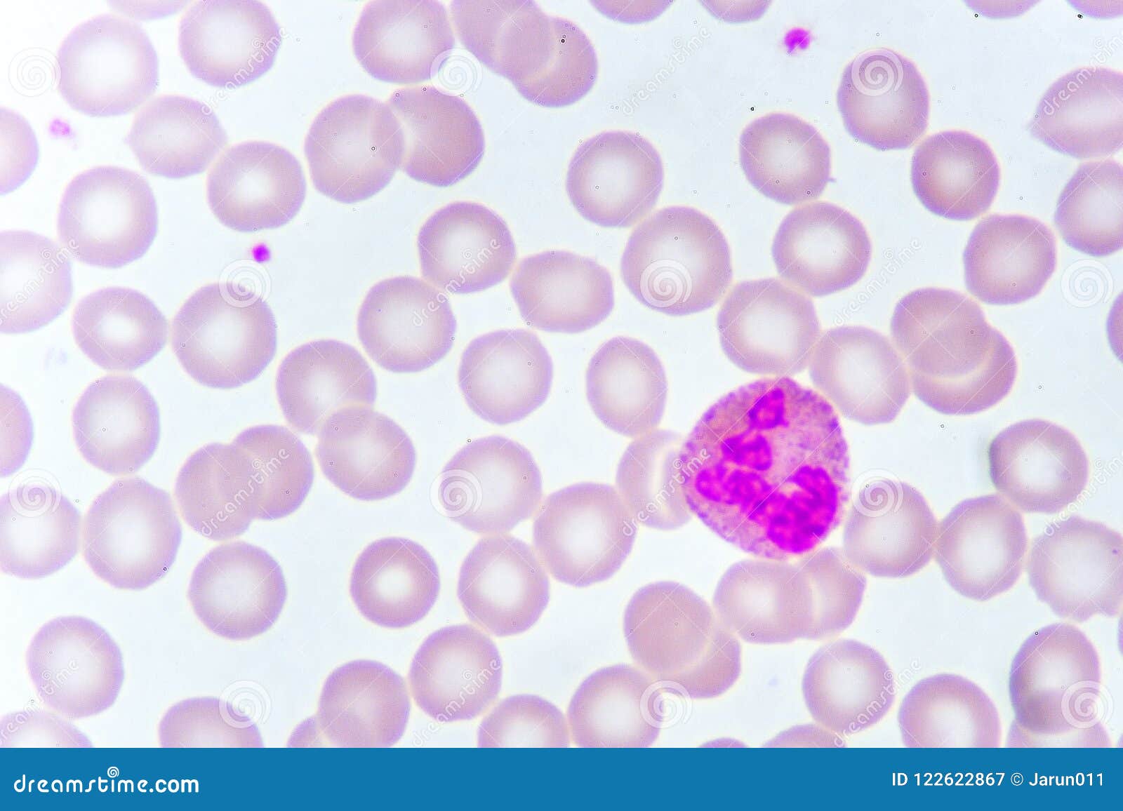 White Blood Cell in Blood Smear Stock Image - Image of hemophilia ...