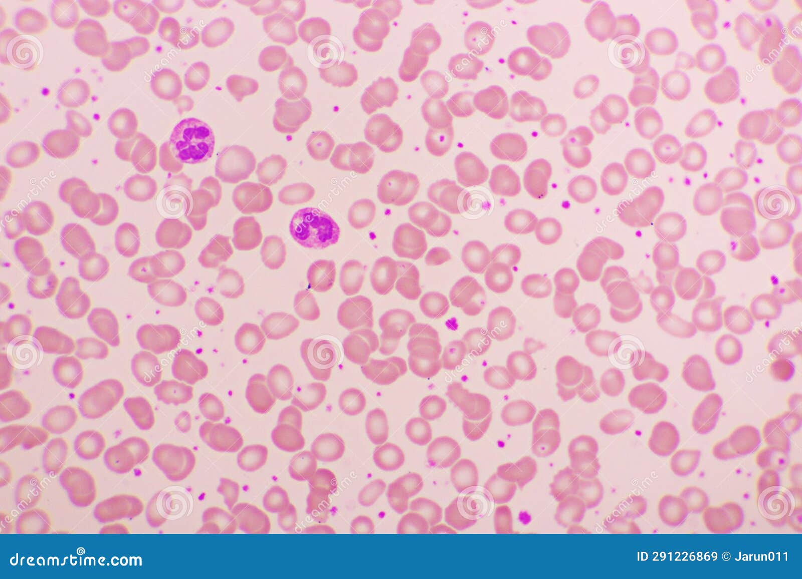 White Blood Cell in Blood Smear Stock Image - Image of thalassemia ...