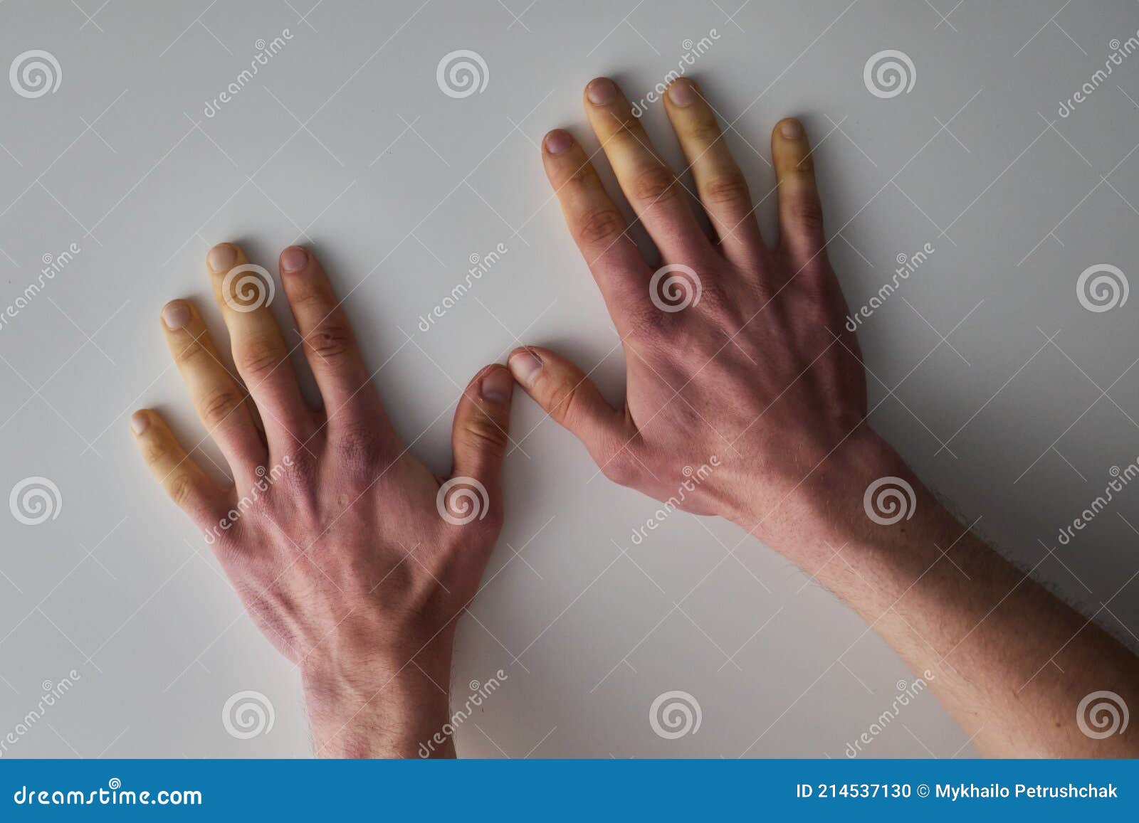 White Fingers from the Cold, Poor Blood Circulation,close Up Stock ...