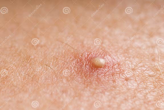 White head pimple stock image. Image of pustule, boil - 12097717