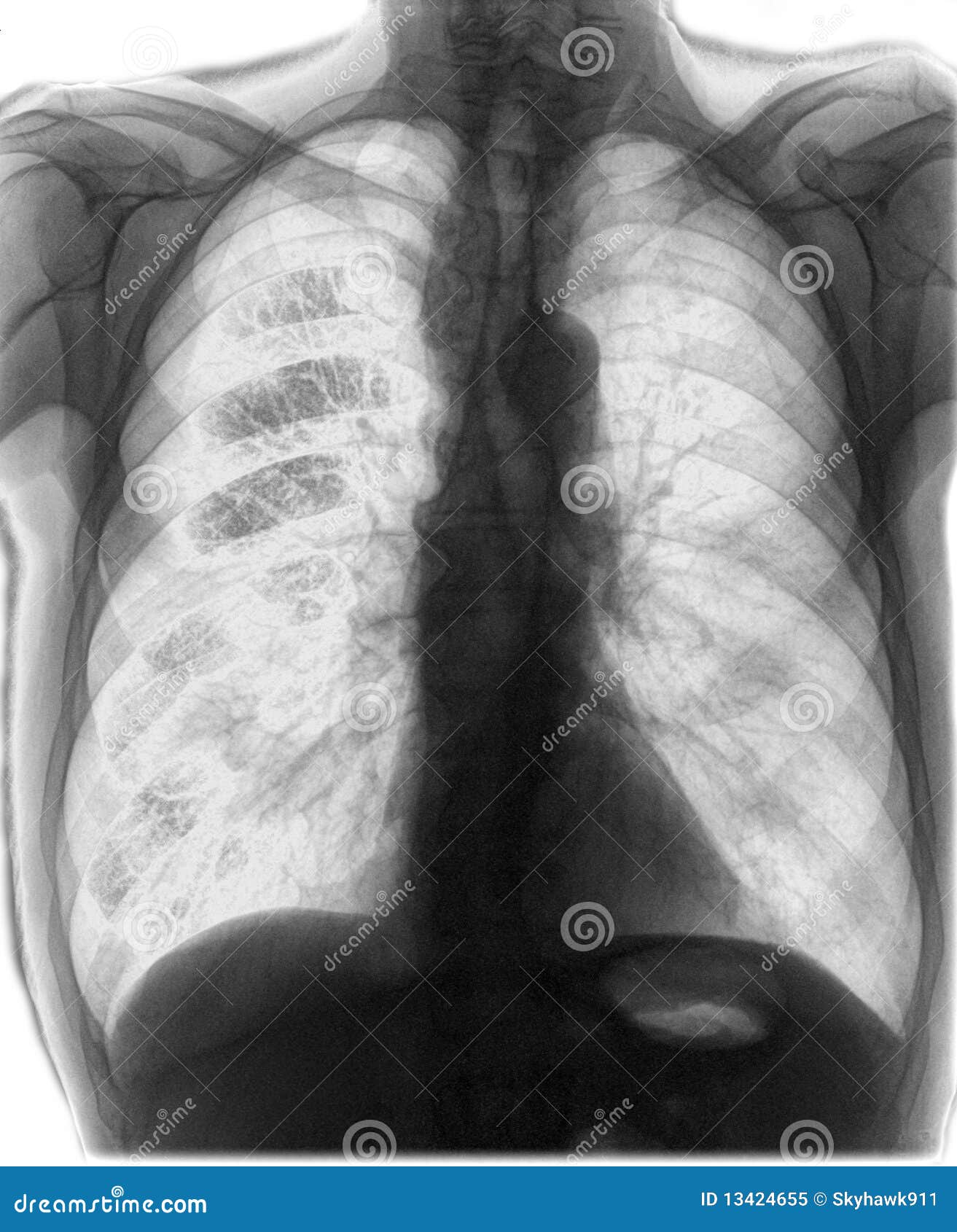 White lungs stock image. Image of column, bone, breathing - 13424655