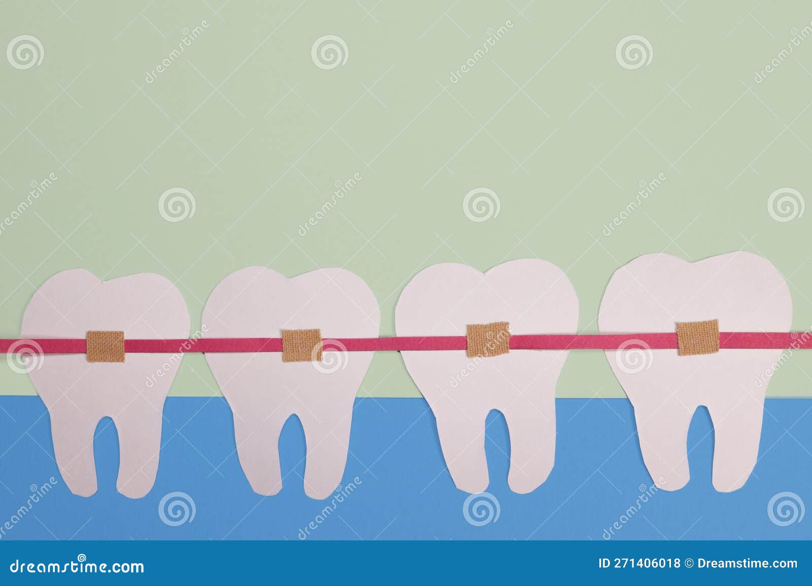 White Paper Teeth in Dental Braces Stock Photo - Image of medicine ...