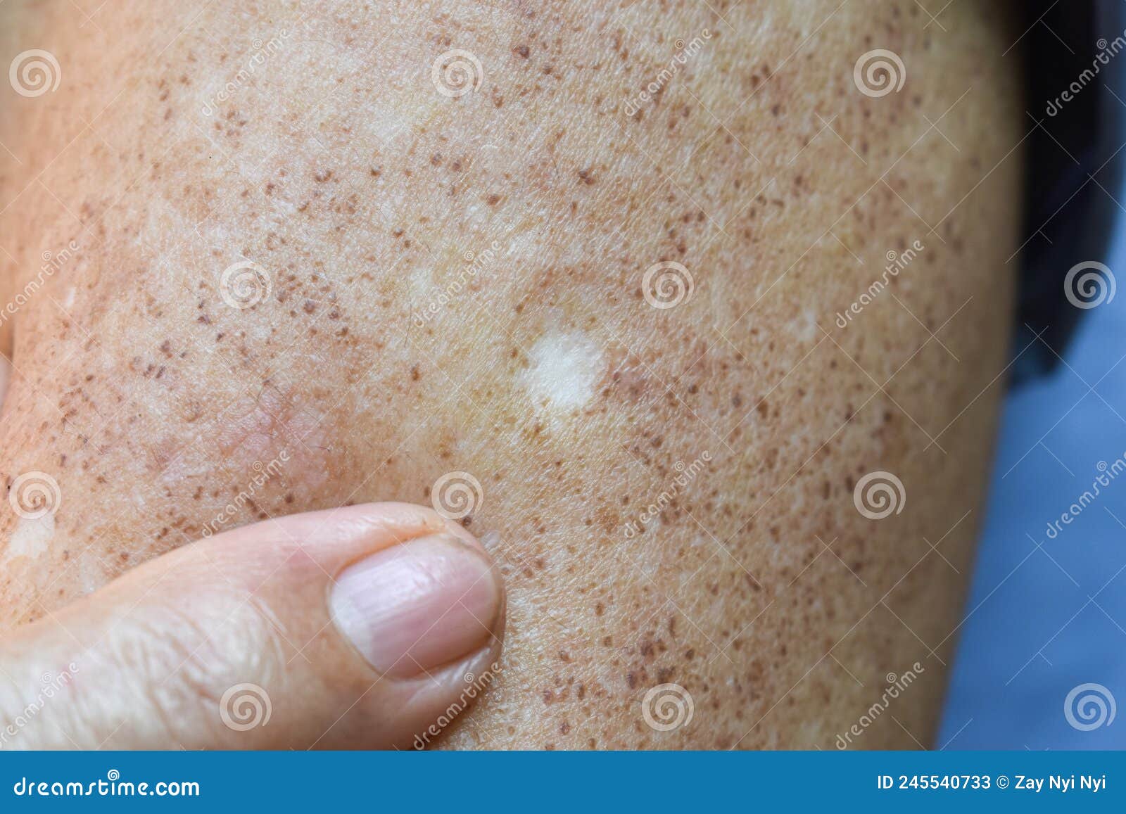 White patch on the arm stock image. Image of health - 245540733