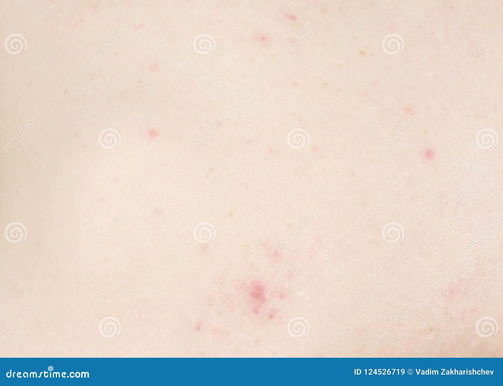 White and Red Pimples and Acne on the Man`s Back. Stock Image - Image ...
