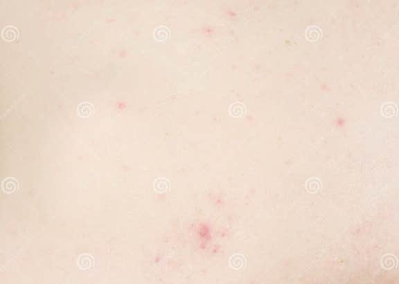White and Red Pimples and Acne on the Man`s Back. Stock Image - Image ...