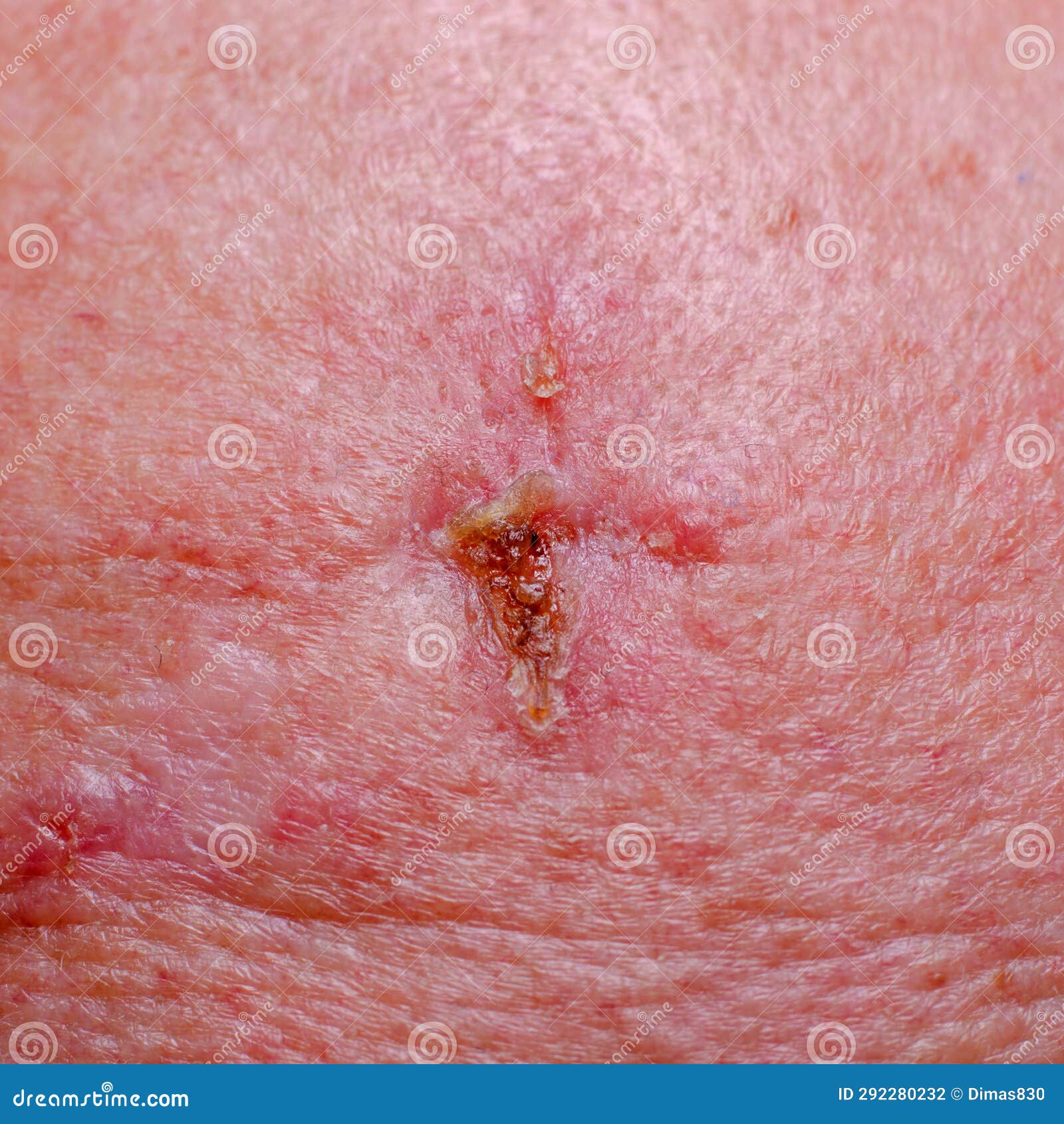 White Skin Cancer Basalioma Stock Photo - Image of woman, doctor: 292280232