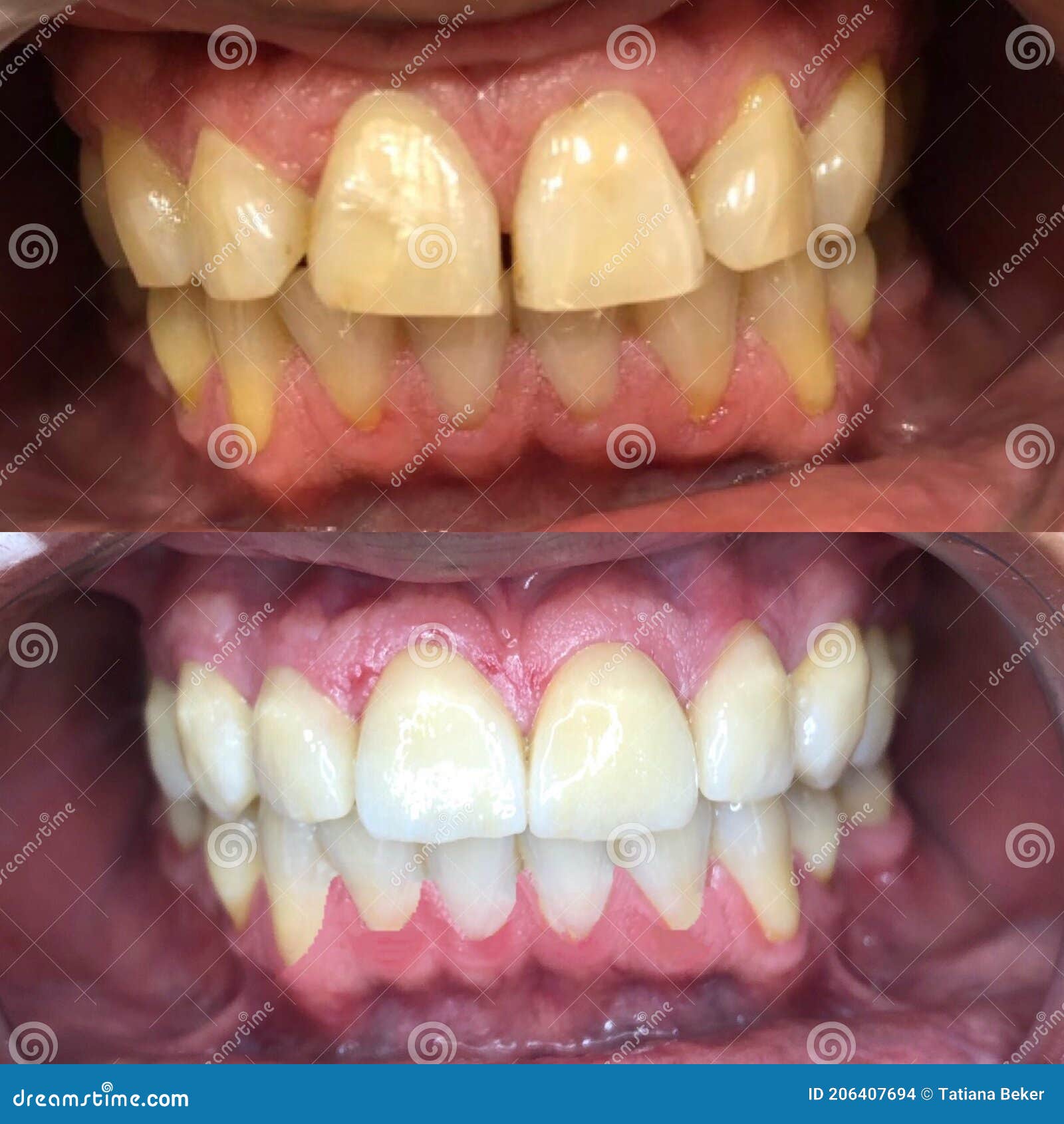 Whitening, Diastema Closure Stock Photo - Image of veneers, feldespatic ...