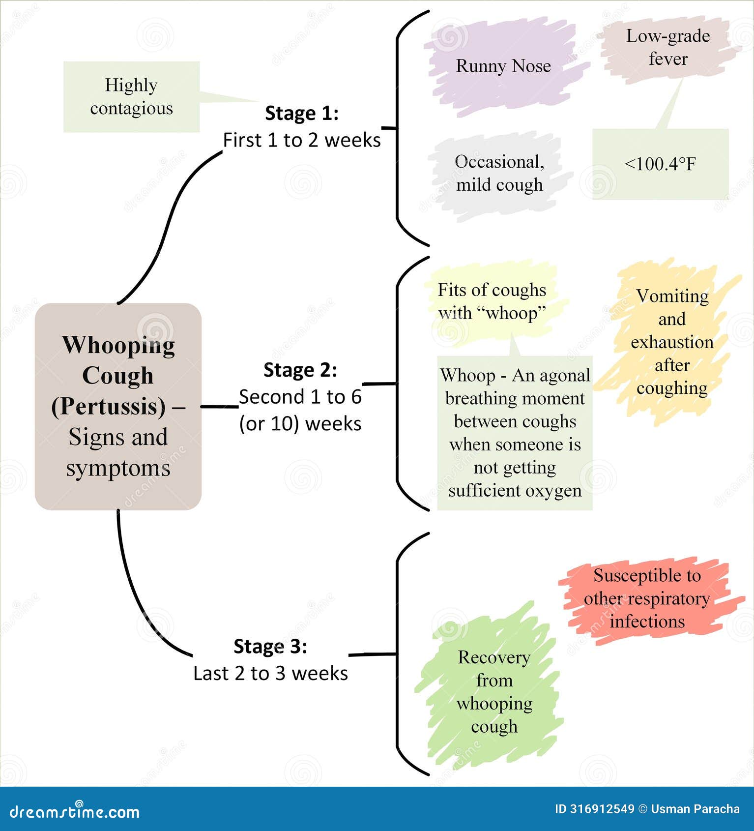 Whooping Cough (pertussis) - Signs and Symptoms Stock Illustration ...