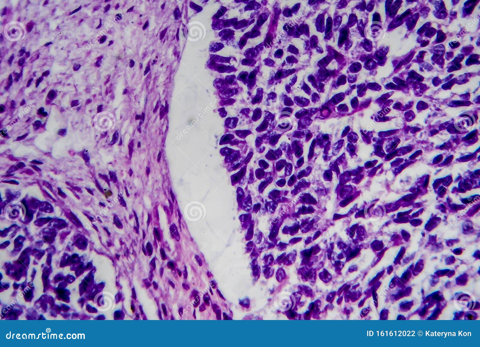 Wilms Tumor, Light Micrograph Stock Photo - Image of medical ...