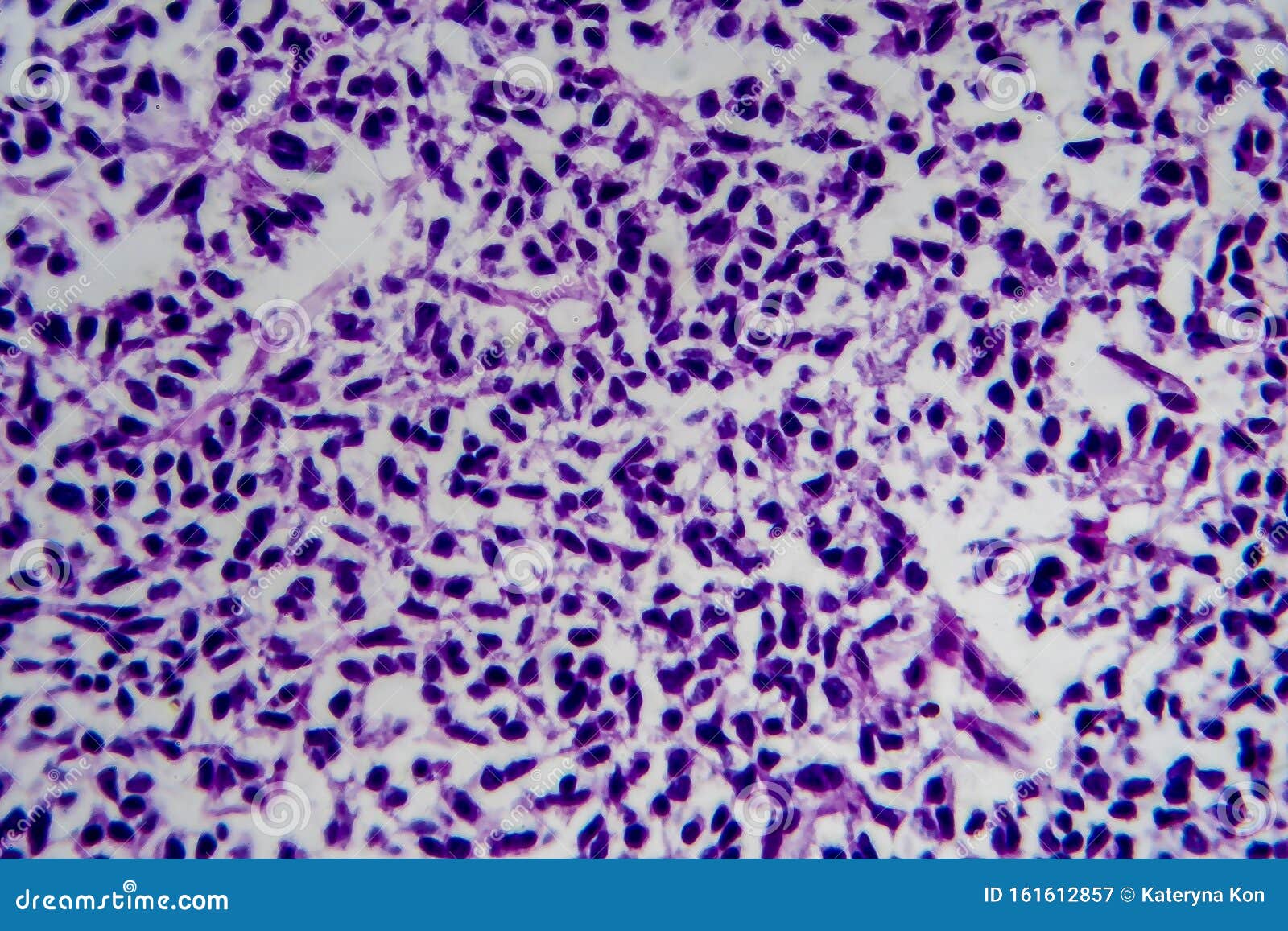 Wilms Tumor, Light Micrograph Stock Image - Image of pathology ...