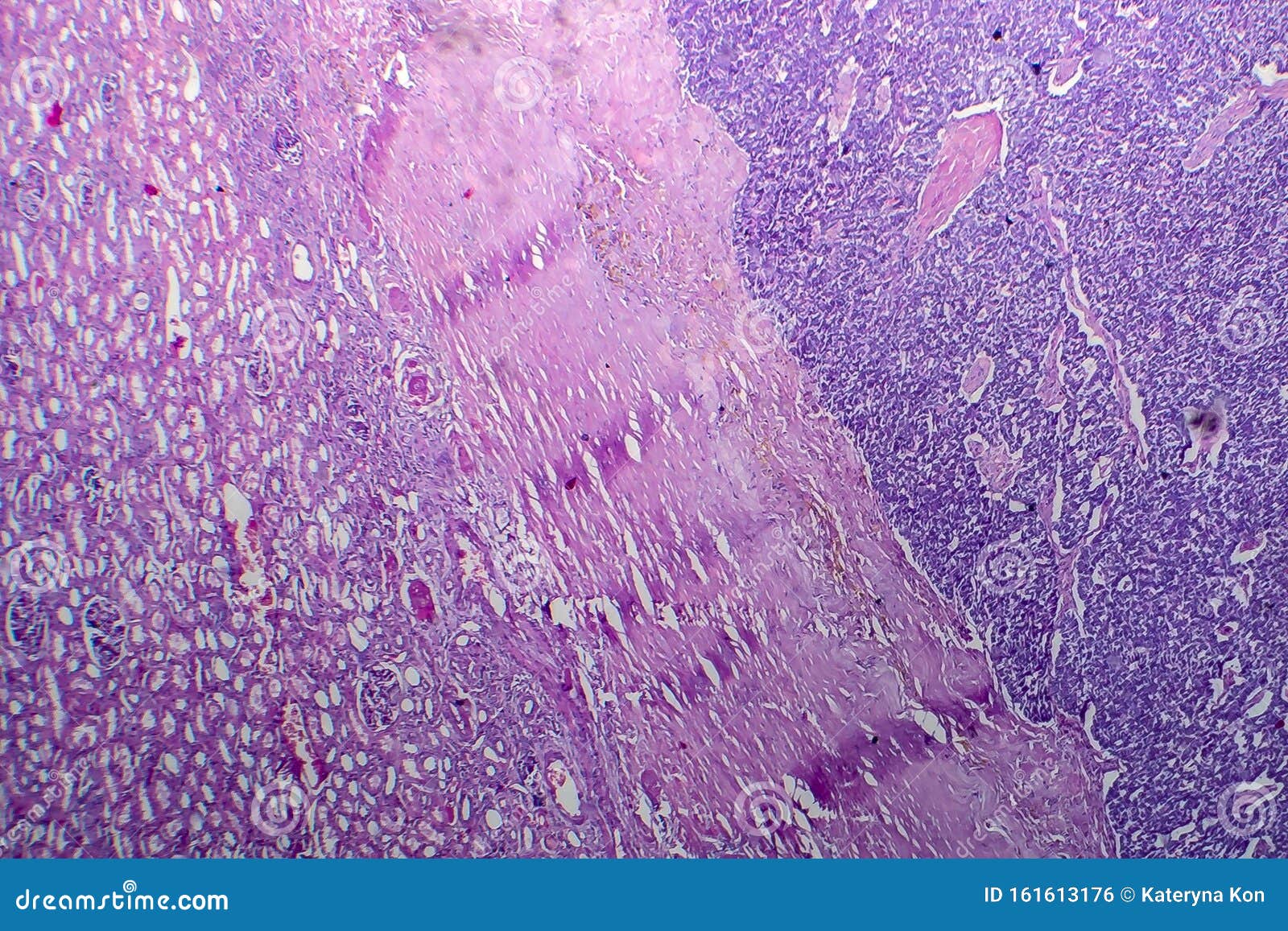 Wilms Tumor, Light Micrograph Stock Photo - Image of cancer, oncology ...