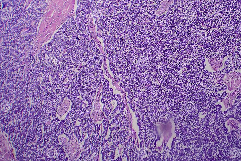 Wilms Tumor, Light Micrograph Stock Image - Image of microscope ...