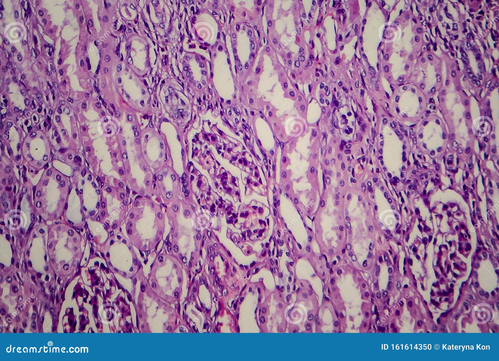 Wilms Tumor, Light Micrograph Stock Photo - Image of medicine, eosin ...