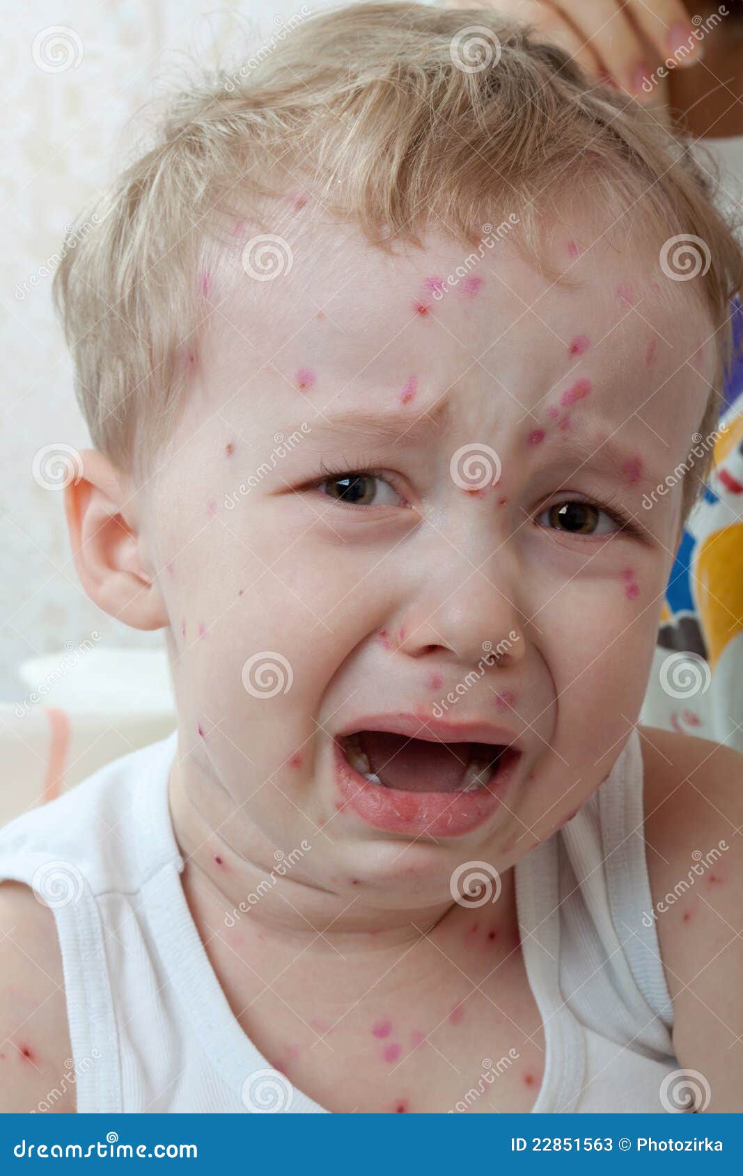 Windpocken stockbild. Bild von hautausschlag, fieber - 22851563