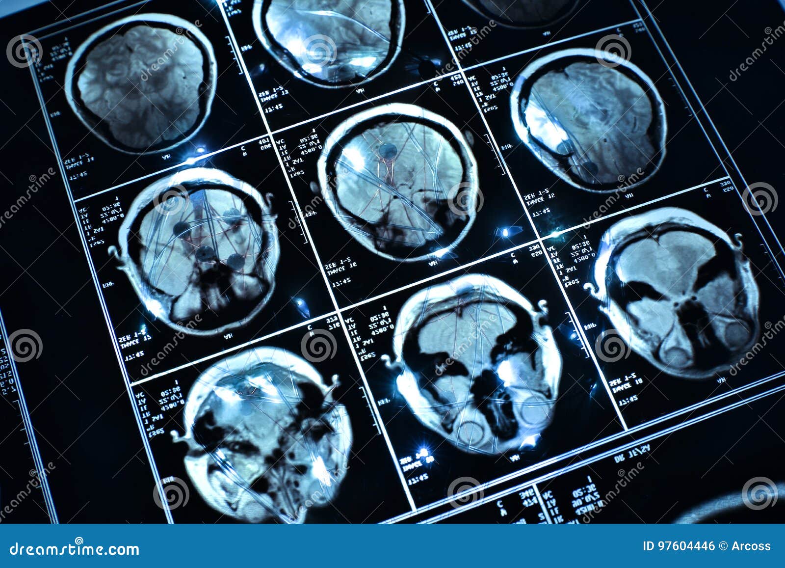 Wire on brain stock photo. Image of science, psychiatry - 97604446