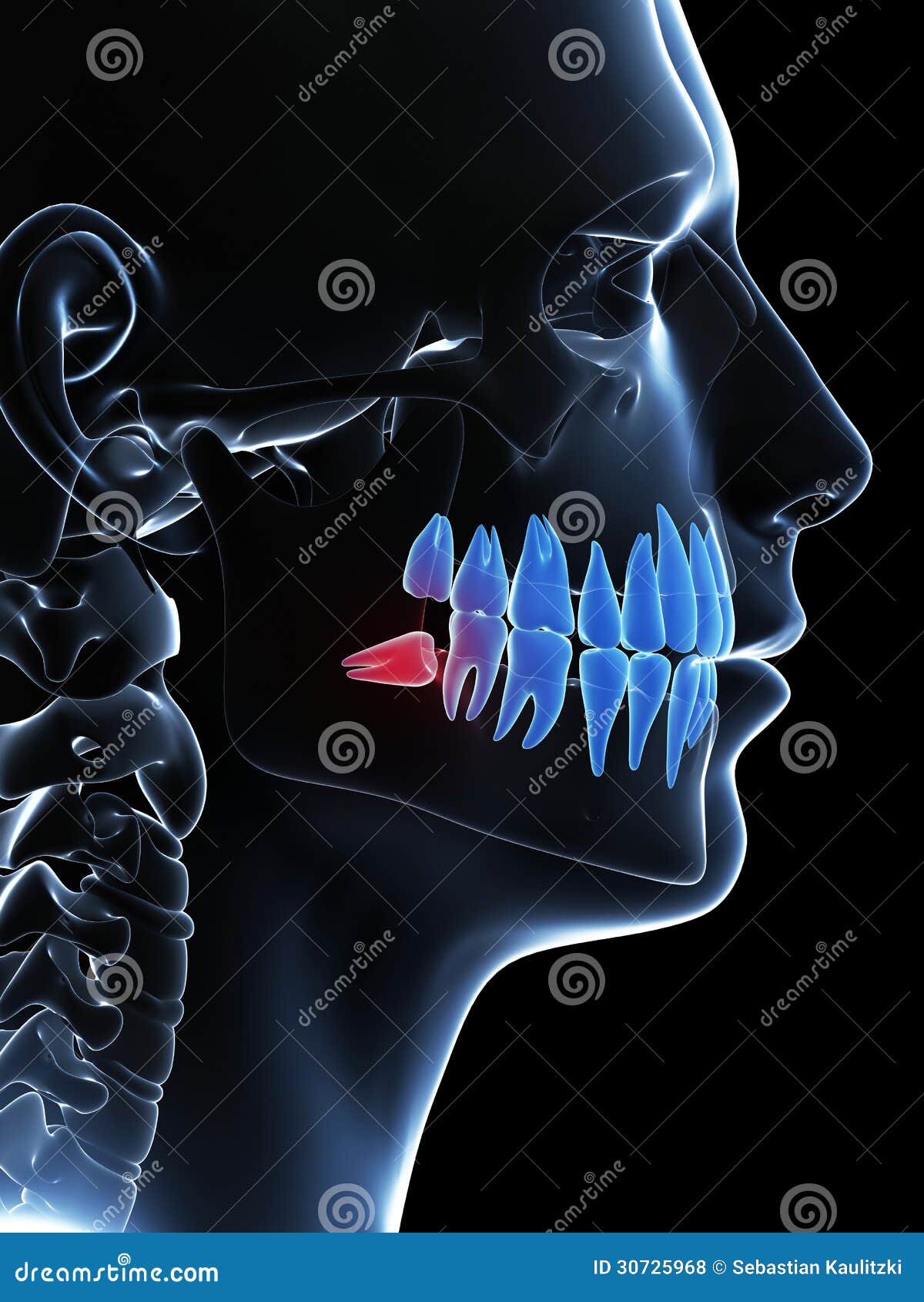 Wisdom teeth stock illustration. Illustration of impacted - 30725968