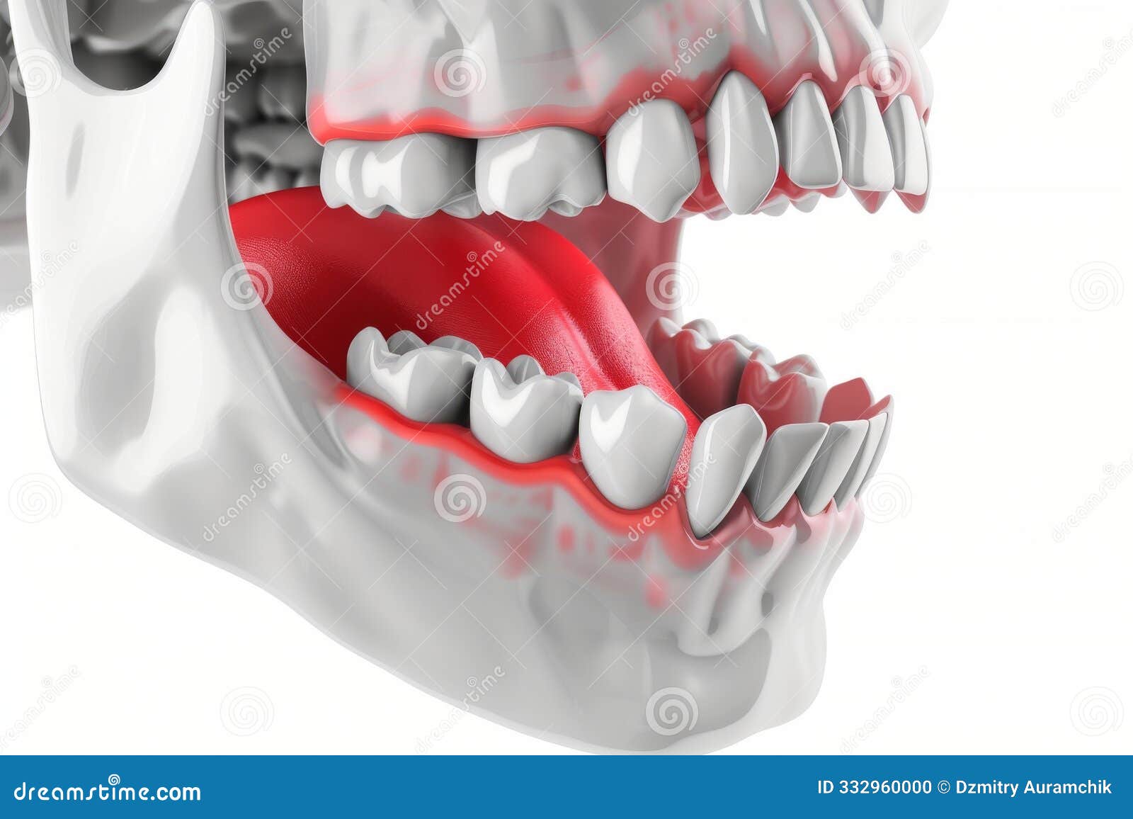 Wisdom Teeth Impaction To Second Molar in 3D. Medically Accurate ...