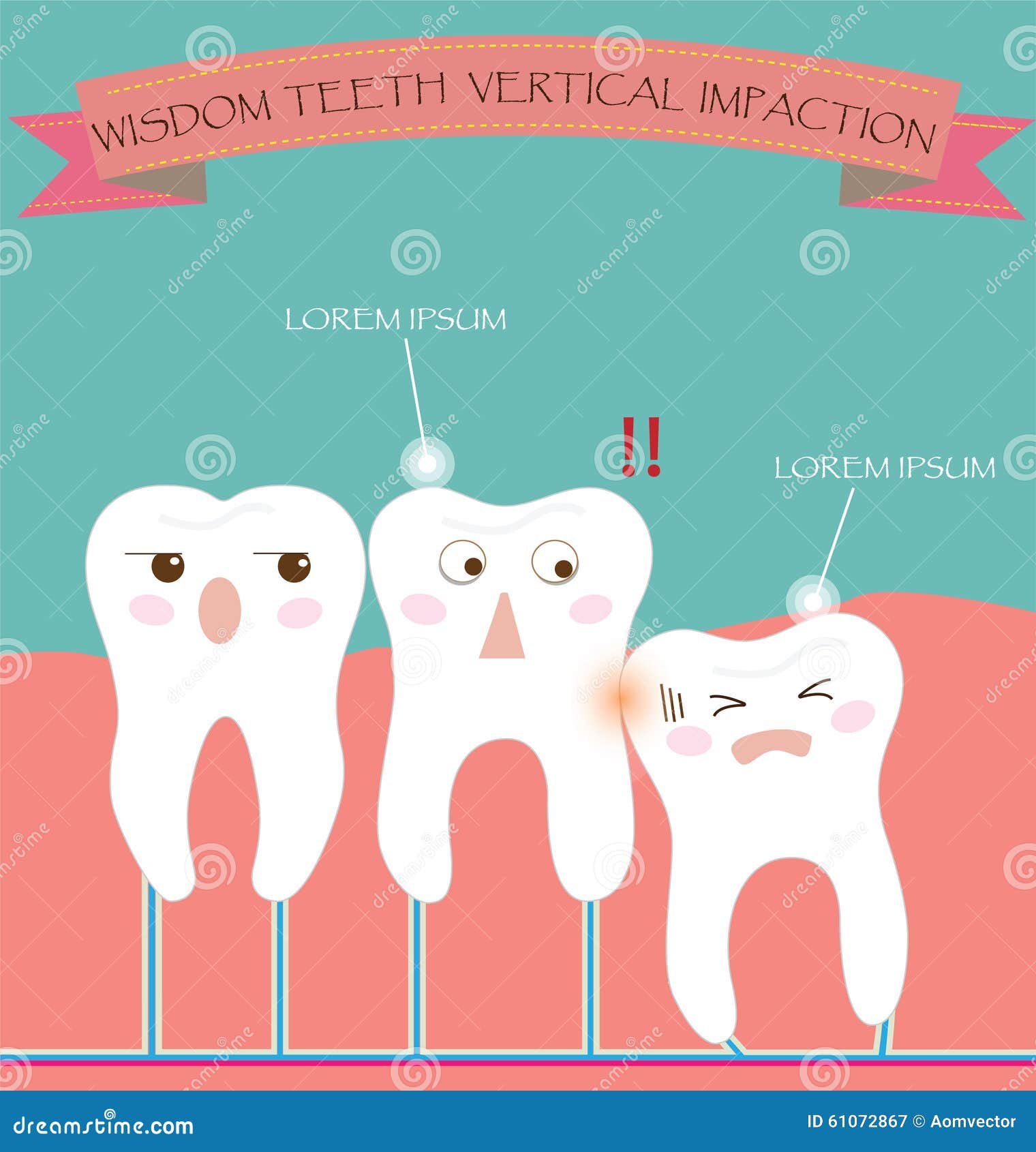 Distal Impaction Of Wisdom Tooth. Medically Accurate Tooth 3D ...