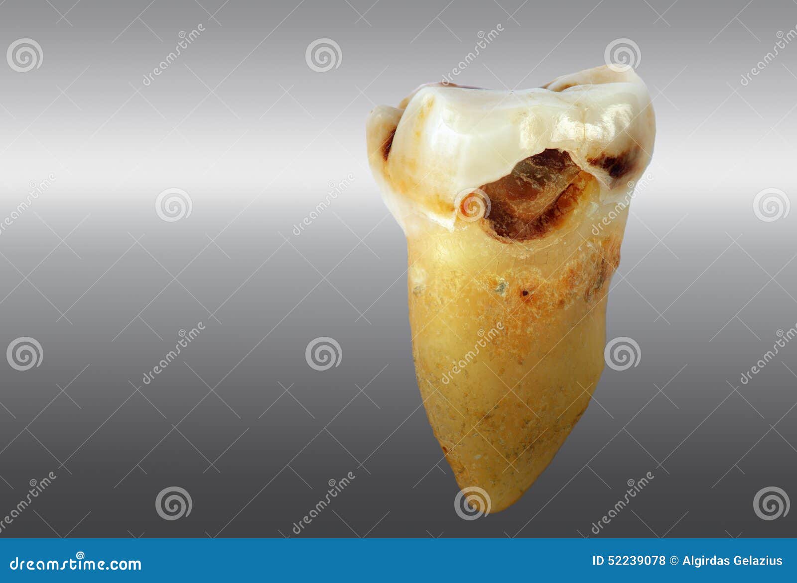Wisdom-tooth Affected by Caries Stock Photo - Image of human, cavity ...