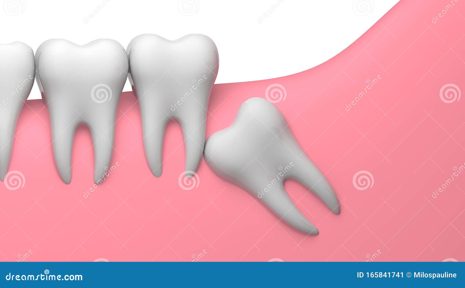 Wisdom Tooth Angular Impaction Illustration, 3D-rendering, White ...