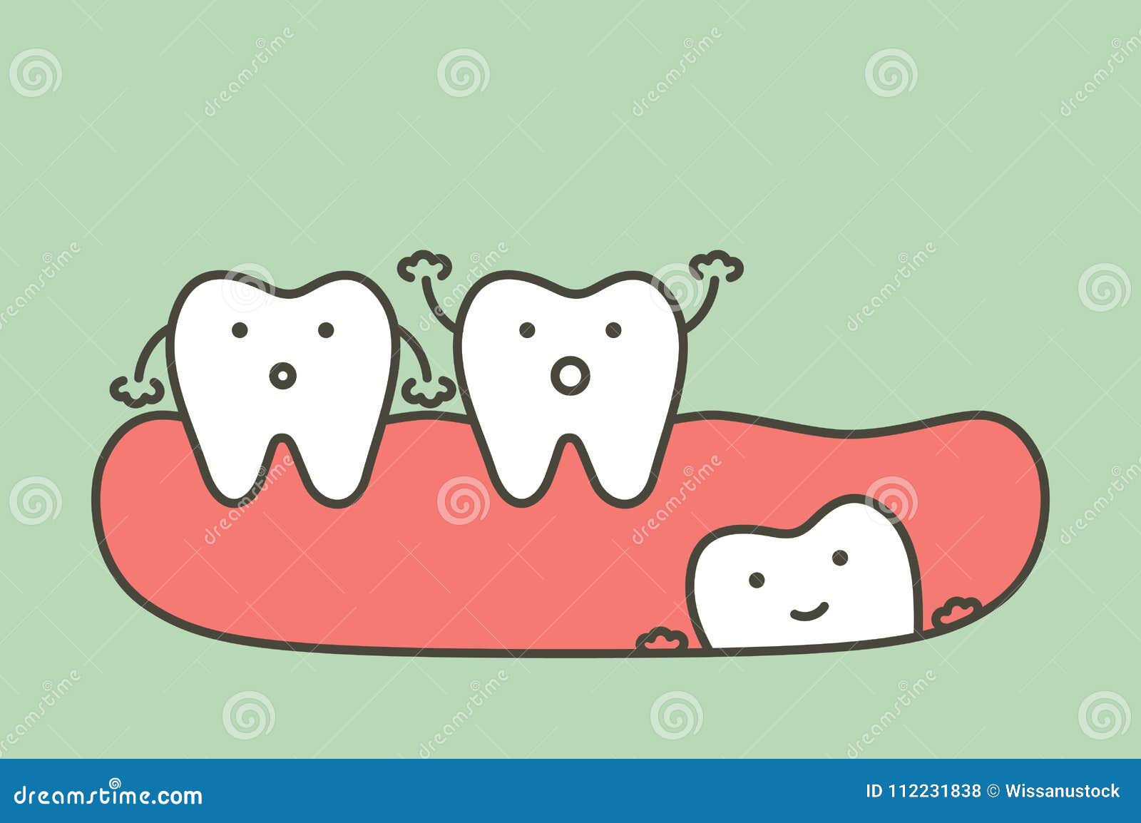 Wisdom Tooth Angular Or Mesial Impaction Affect To Other Teeth Vector ...