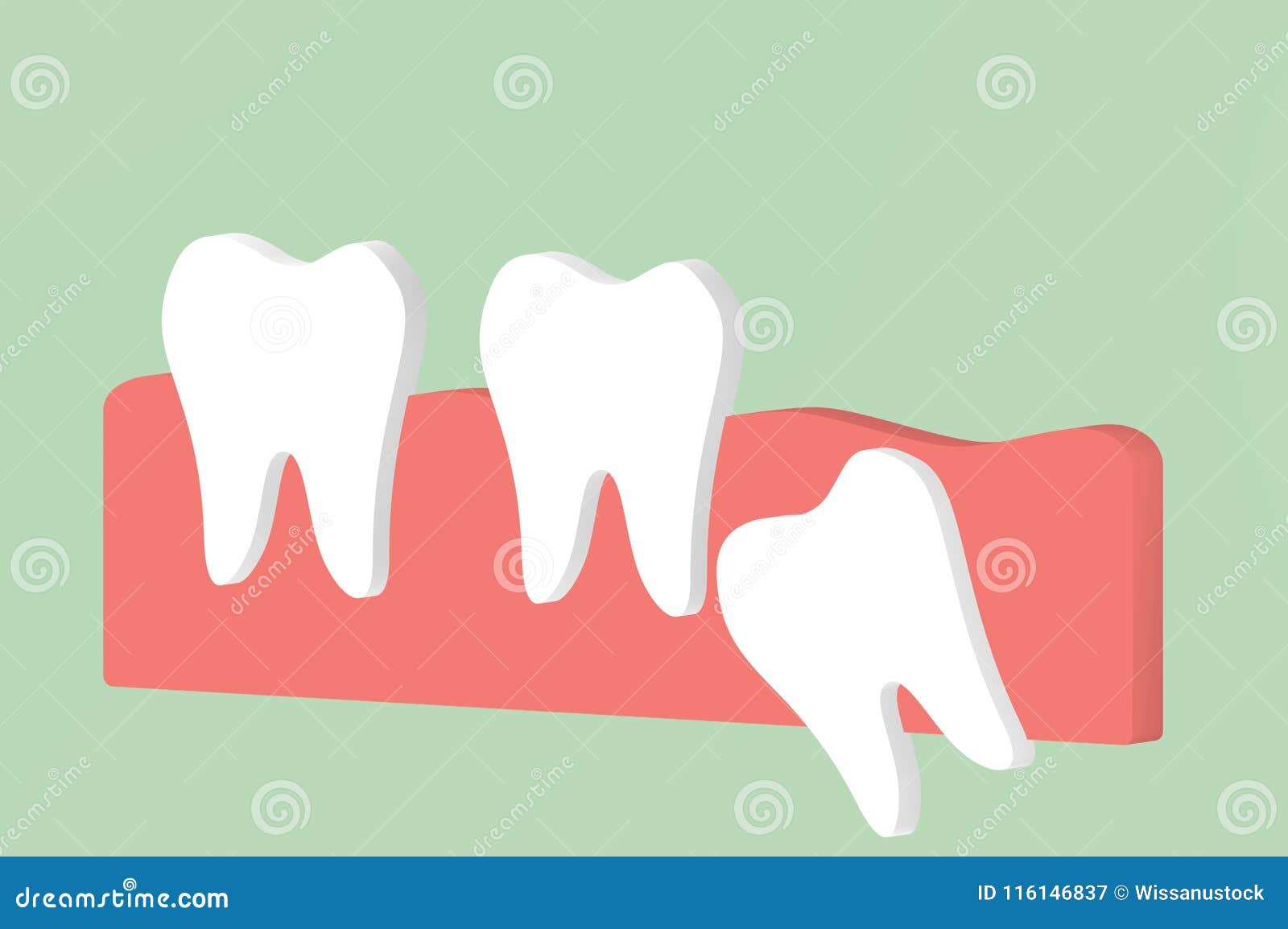 Wisdom Tooth Angular or Mesial Impaction Affect To Other Teeth Stock ...