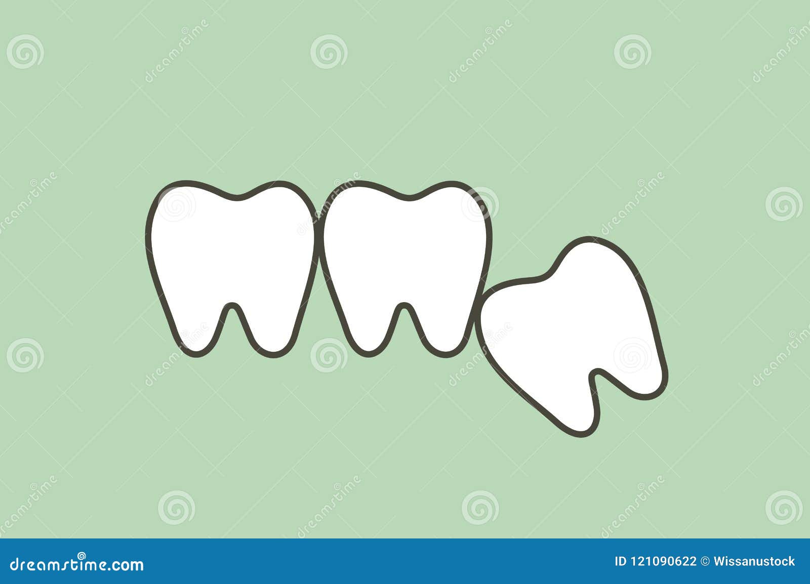 Wisdom Tooth Angular or Mesial Impaction Affect To Other Teeth Stock ...