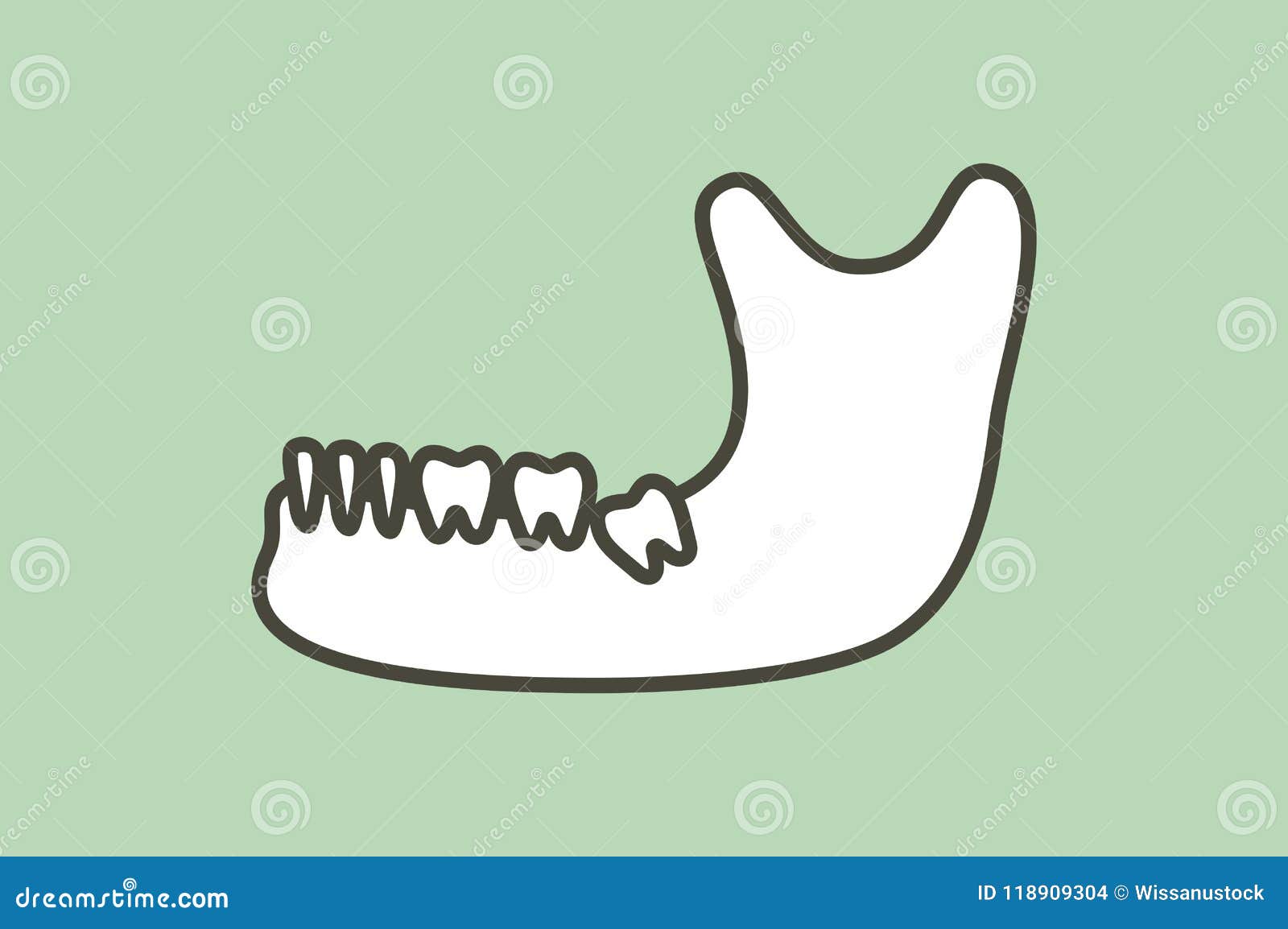 Wisdom Tooth Angular or Mesial Impaction in Mandible or Lower Jaw Stock ...