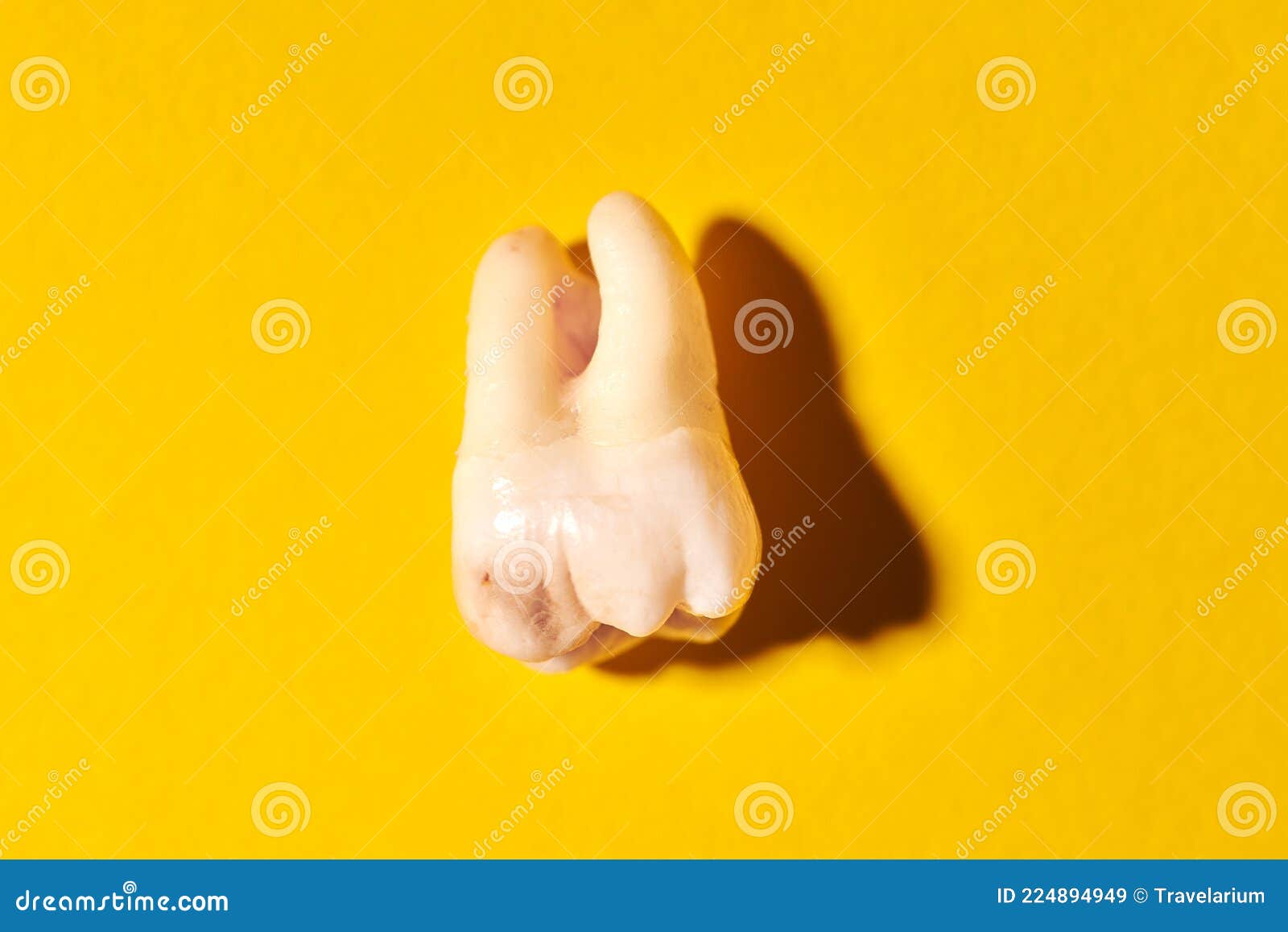 Wisdom Tooth with Tooth Decay, Yellow Background Stock Image - Image of ...