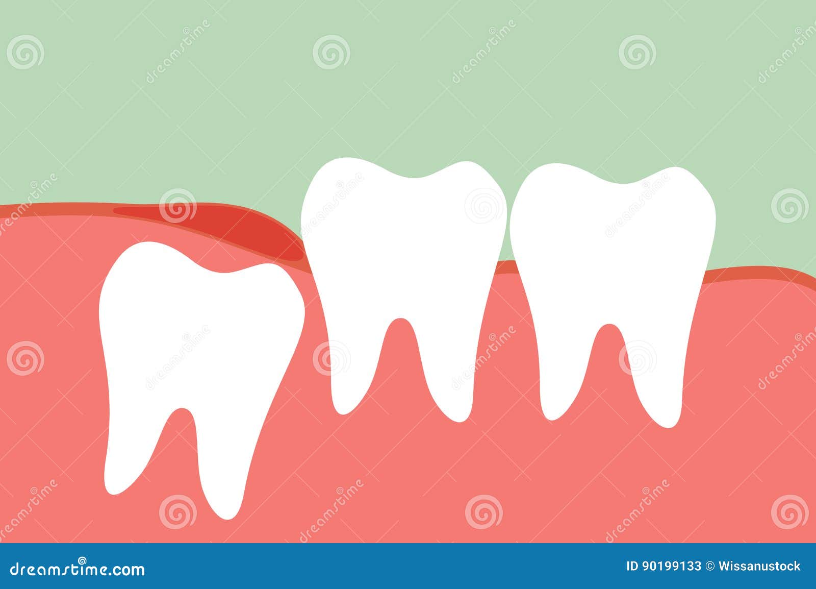 Wisdom tooth stock vector. Illustration of dental, cause - 90199133