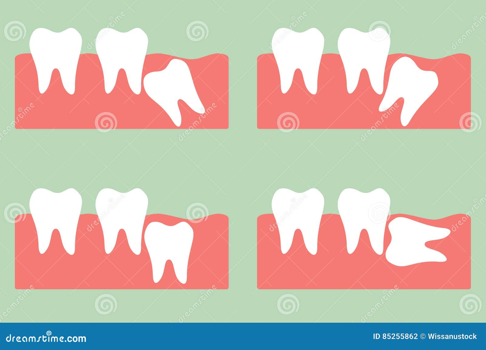 Distal Impaction Of Wisdom Tooth. Medically Accurate Tooth 3D ...
