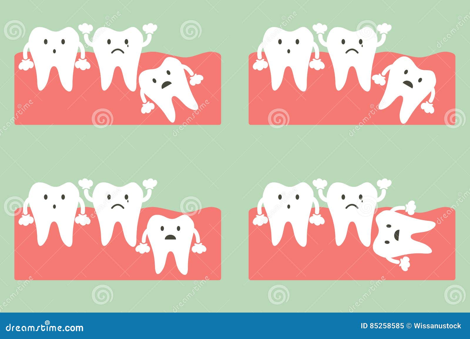 Distal Impaction Of Wisdom Tooth. Medically Accurate Tooth 3D ...