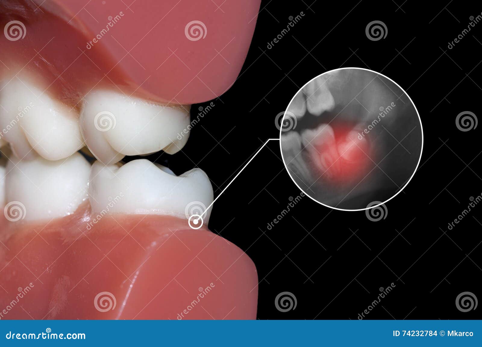 Wisdom Tooth Display Toothache Illustration Stock Photo - Image of ...