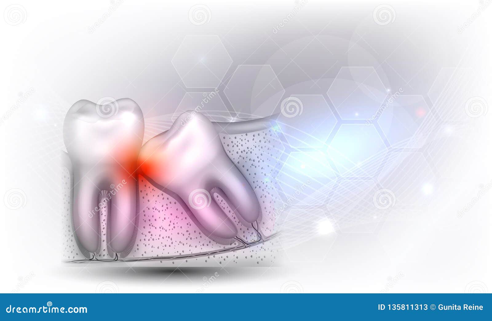 Wisdom tooth stock vector. Illustration of gums, dentistry - 135811313