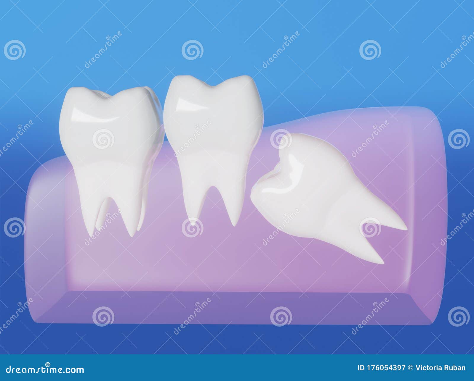 Wisdom Tooth Grows Wrong, Wisdom Tooth Problem, Horizontal Position of ...