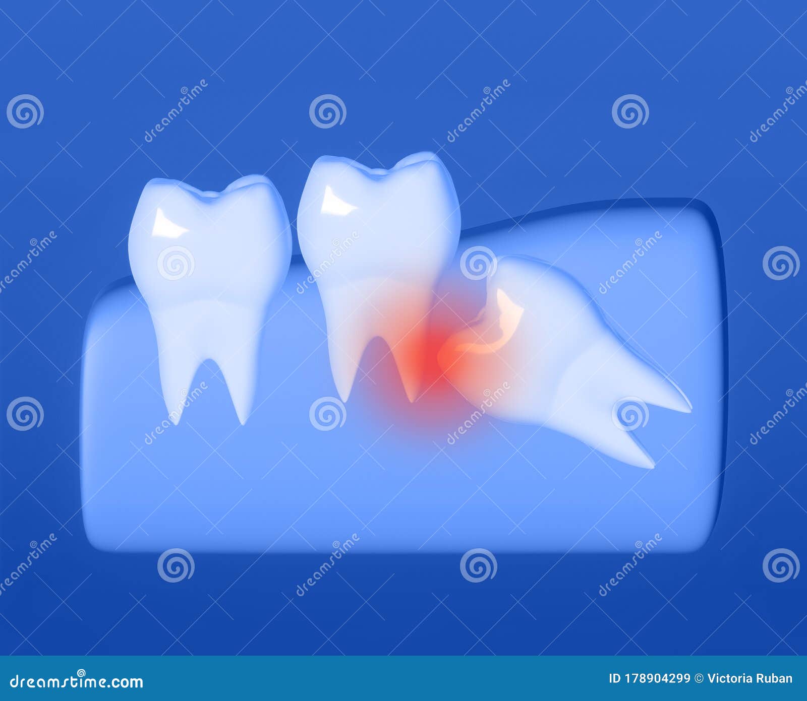 Wisdom Tooth Grows Wrong, Wisdom Tooth Problem, Horizontal Position of ...