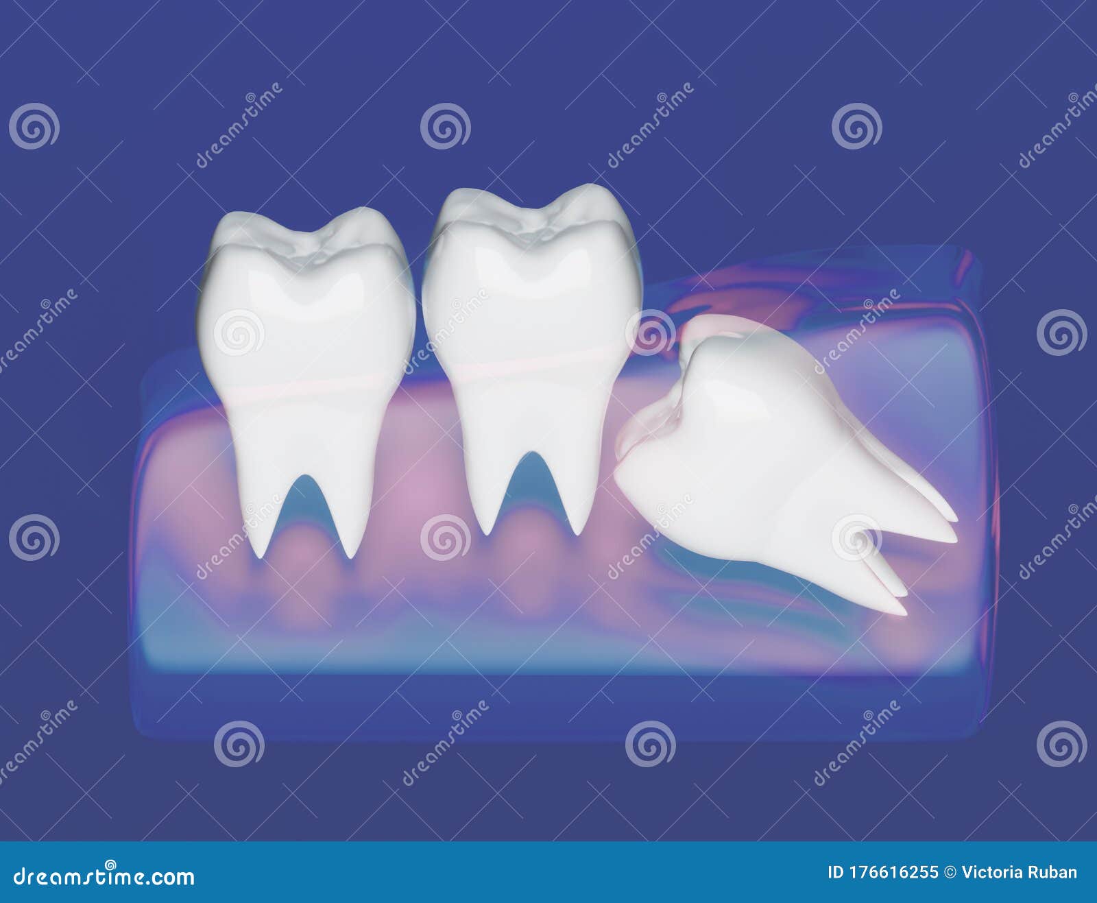 Wisdom Tooth Grows Wrong, Wisdom Tooth Problem, Horizontal Position of ...