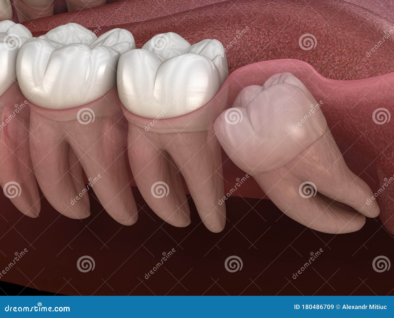 Wisdom Tooth With Impaction At Molar Tooth. Medically Accurate Tooth ...