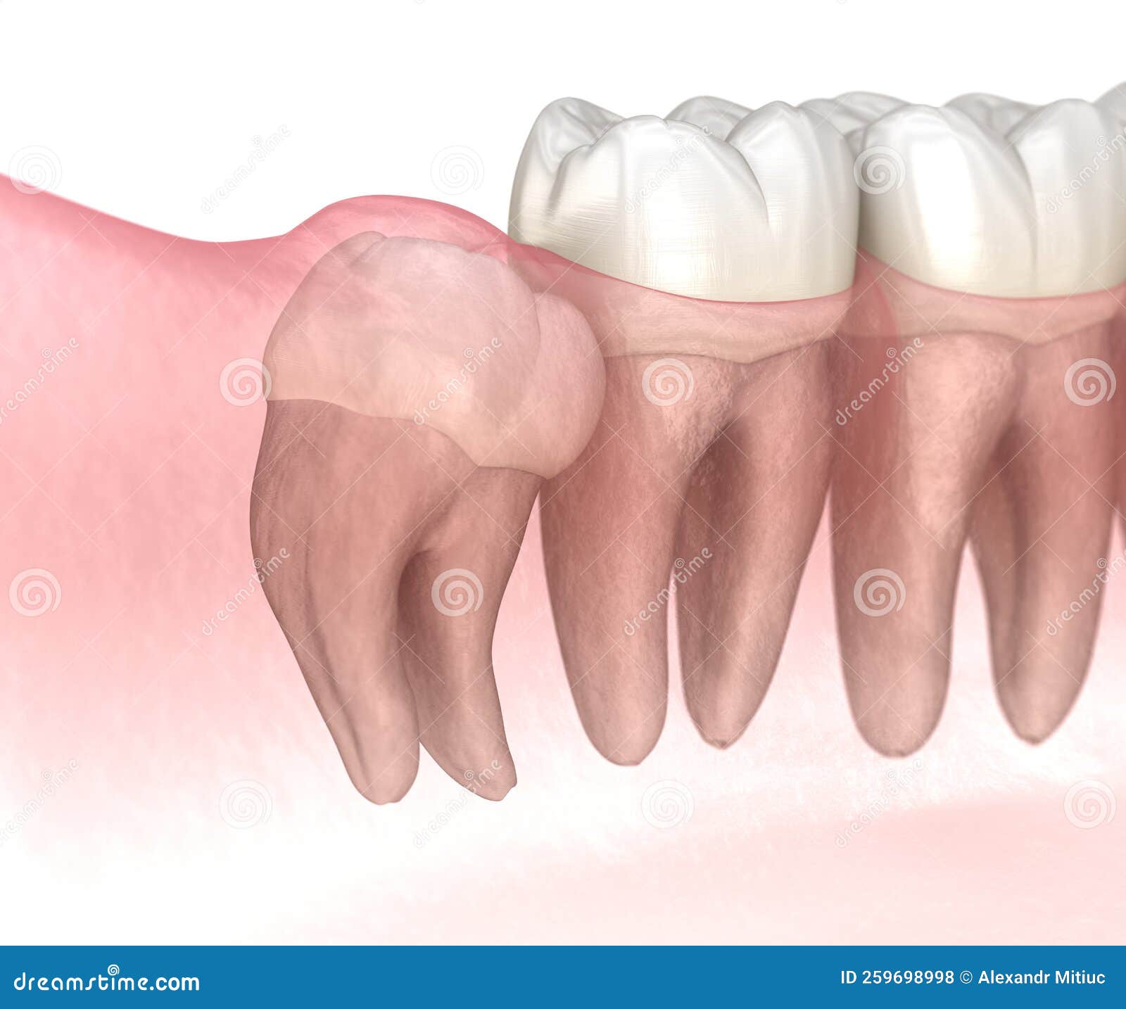 Wisdom Tooth with Impaction at Molar Tooth. Medically Accurate Tooth 3D ...
