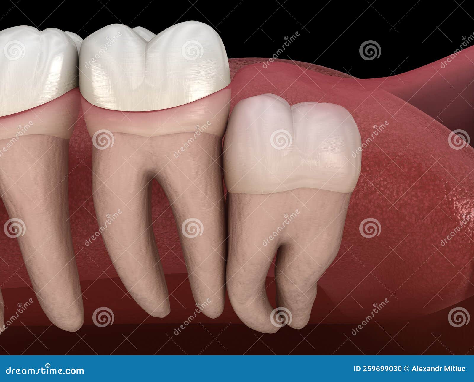 Wisdom Tooth With Impaction At Molar Tooth. Medically Accurate Tooth 3D ...