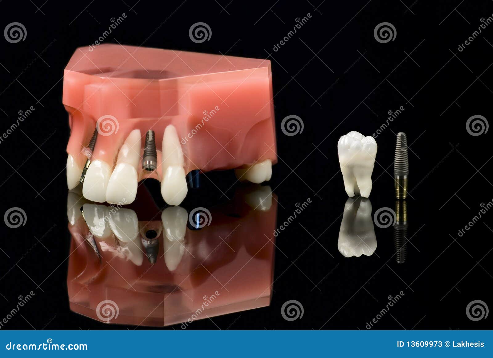 Wisdom Tooth, Implant and Teeth Model Stock Image - Image of equipment ...